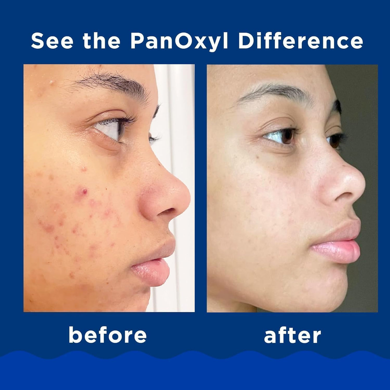 PanOxyl Acne Foaming Wash 10% Benzoyl Peroxide Maximum Strength ...