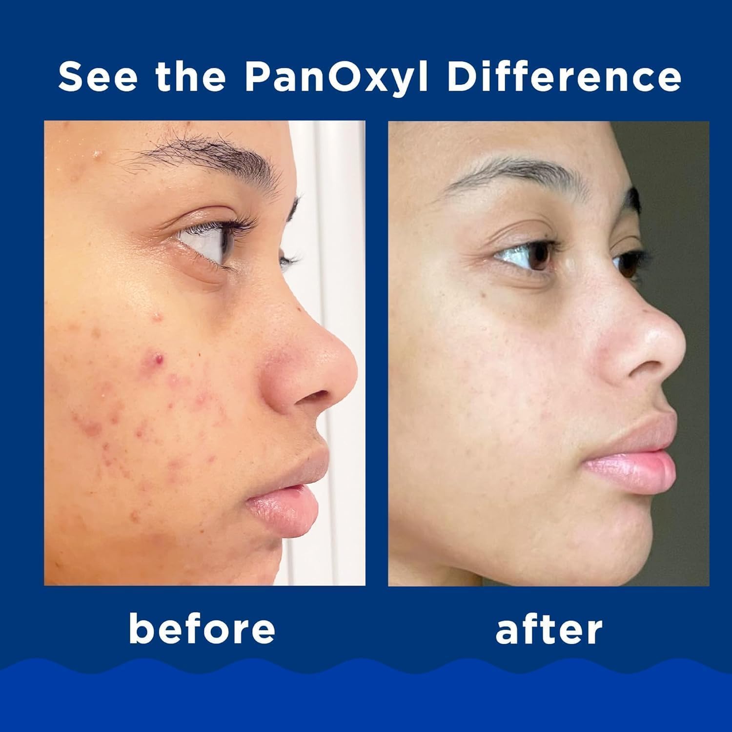 PanOxyl Acne Foaming Wash 10% Benzoyl Peroxide Maximum Strength ...